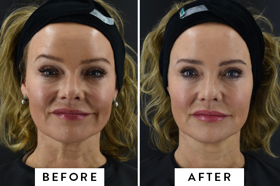 Radiofrequency facial store