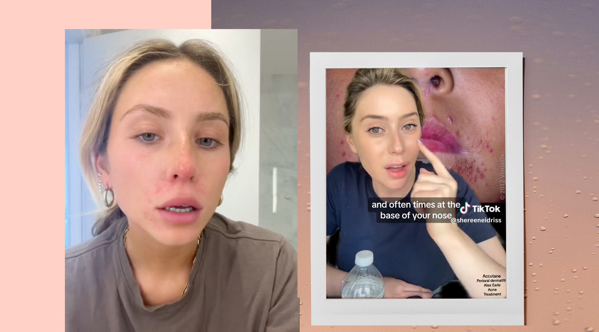 Perioral dermatitis is on the rise: how to know if you have it and how ...