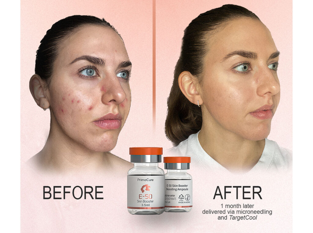 Meet the trending exosome treatment that's bigger on skin-boosting ...