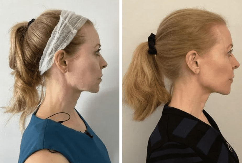 Sofwave: the celebrity-endorsed skin tightening treatment that everyone ...